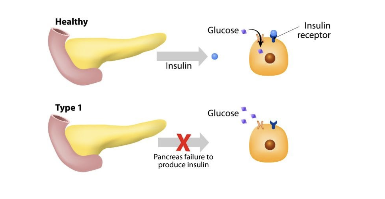 What is Type 1 Diabetes Mellitus - The Endocrine Doc